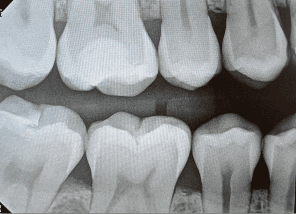 How Dental X-Rays Help Detect Problems Before They Start ...
